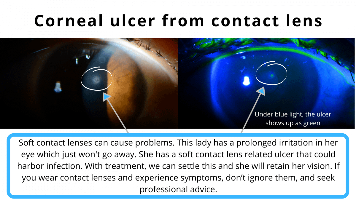 Corneal Erosion - Corneal Surgery Sydney - Dr Anthony Maloof